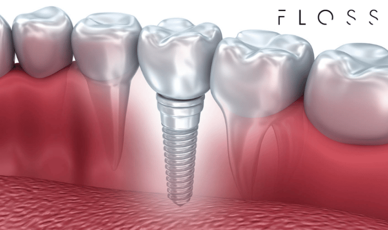 Significance of Dental Implant Treatment