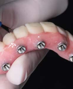 Full Mouth Implants | FLOSS Dental Magnolia, TX