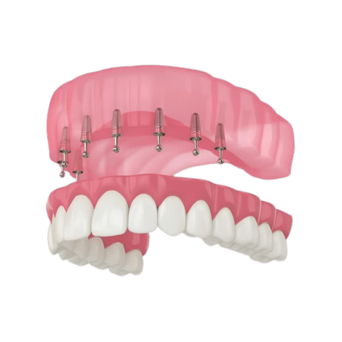 Snap-In Implant Dentures Midtown - FLOSS Dental of Houston Midtown